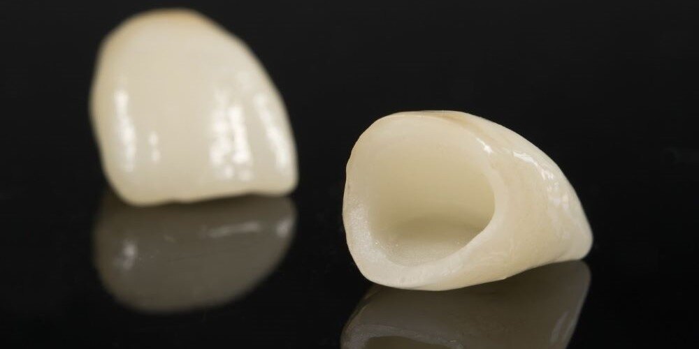 10 Common Causes of Dental Crown Failure | Dental Designs Articles