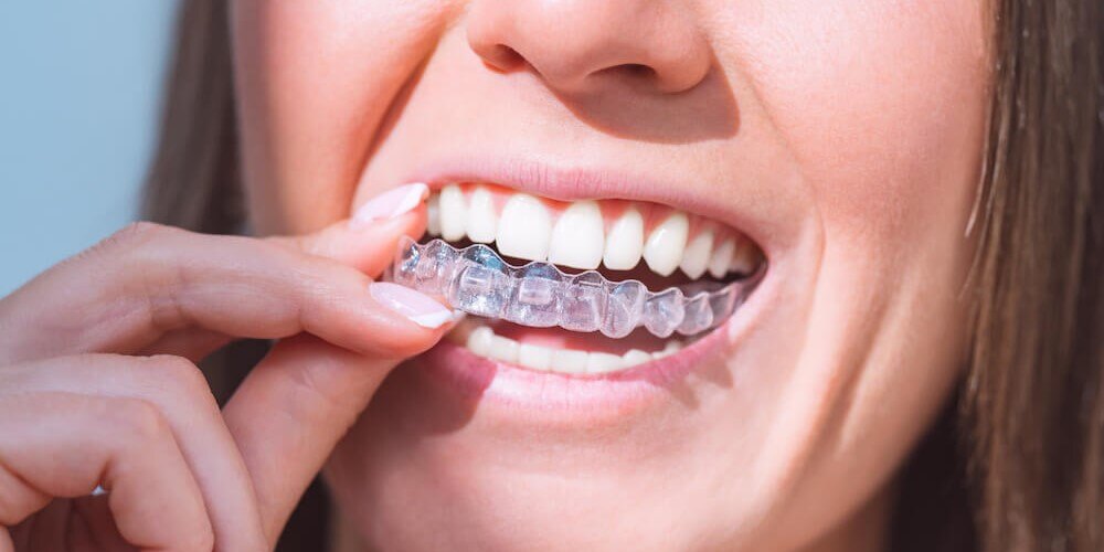 Top 10 FAQs and Insights on Invisalign Attachments - Dental Designs