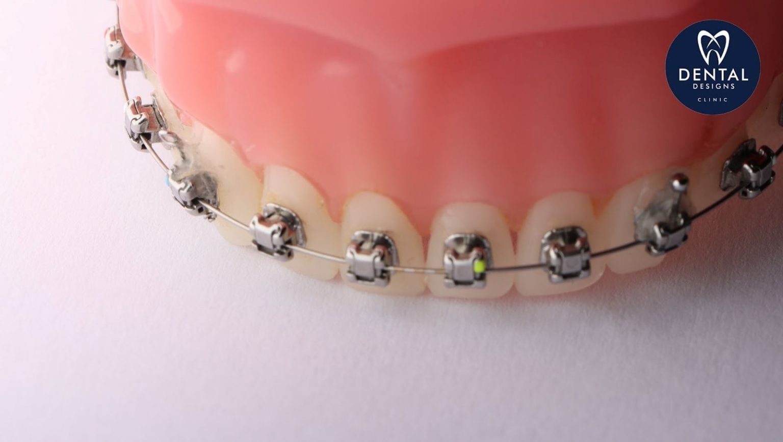 Dental Braces in Singapore Treatment in 2026 – Dental Designs Clinic