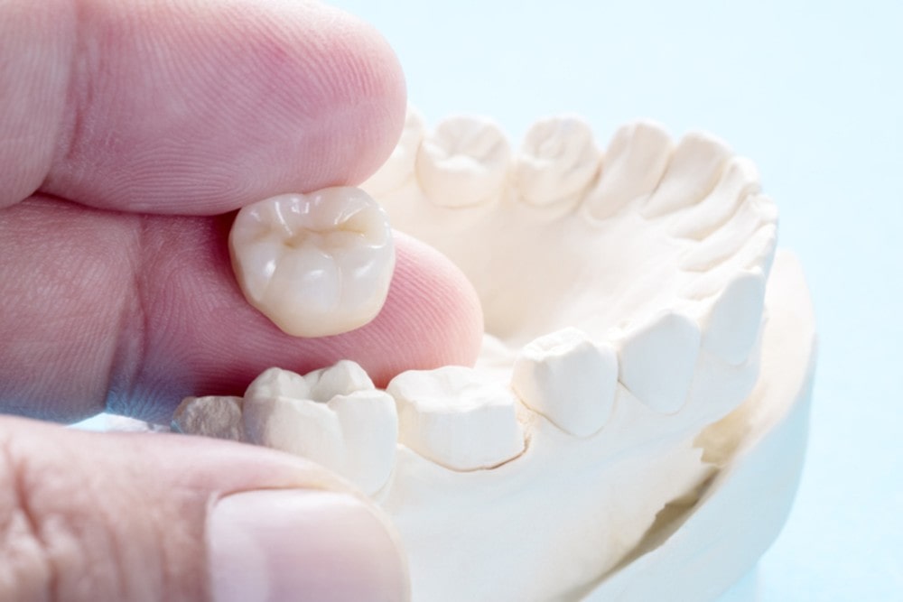 How do I care for my new dental crown? Dental Designs Clinic Singapore
