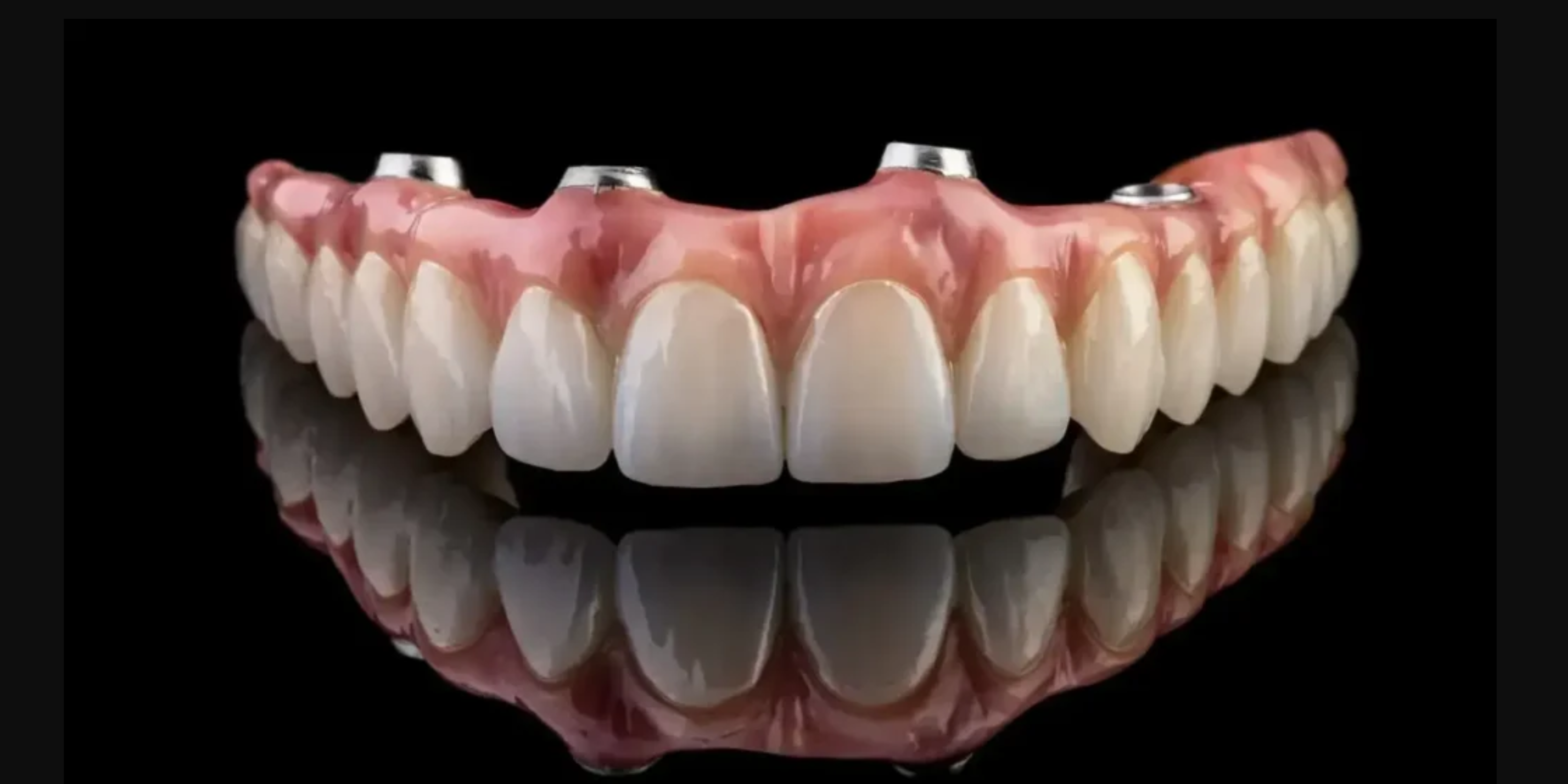 All On 4 Procedure: A Complete Guide - Dental Designs Clinic Singapore