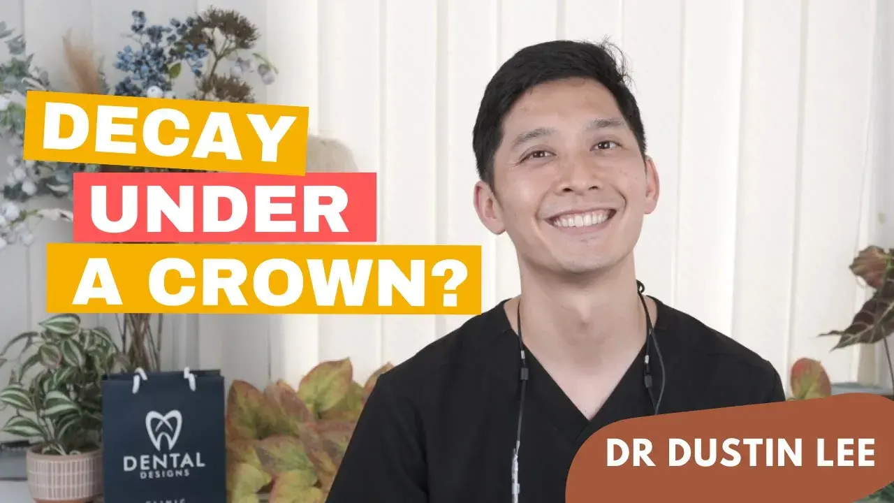 Decay Under A Crown - Explain by Dr. Dustin Lee | Video