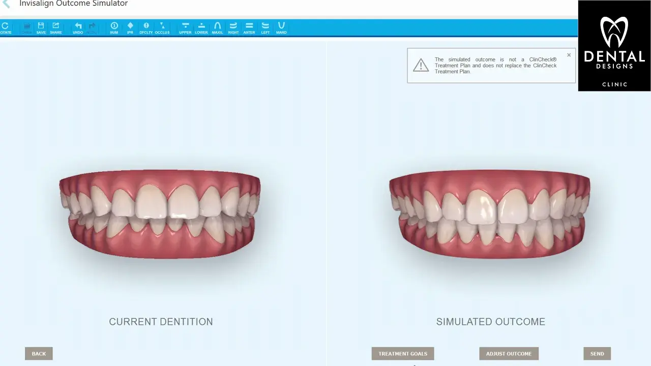Invisalign Outcome Simulator - Invisalign Singapore | Video