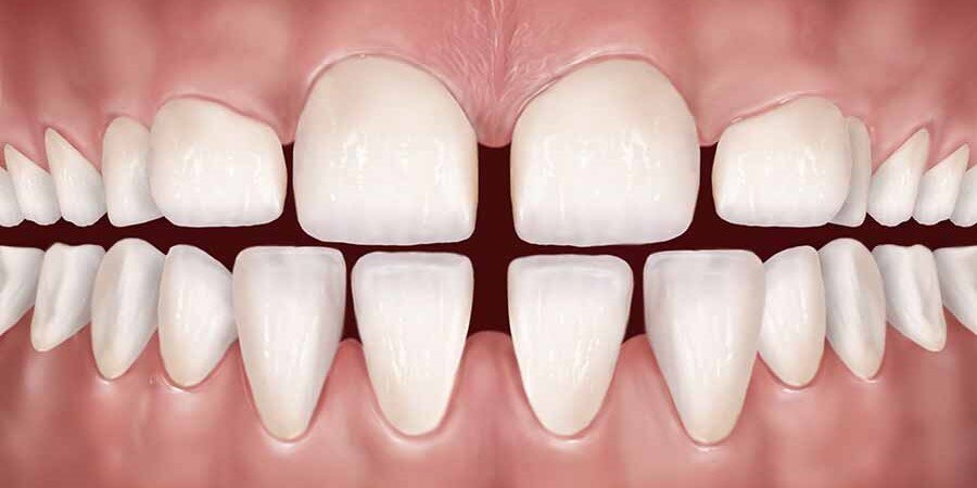 Solutions For Large Gaps Between Teeth - Dental Designs Clinic