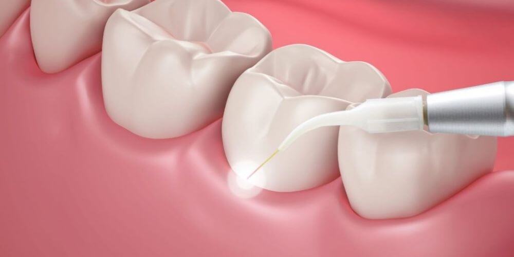 How To Treat Gum Disease With Laser - Dental Designs Clinic 2026