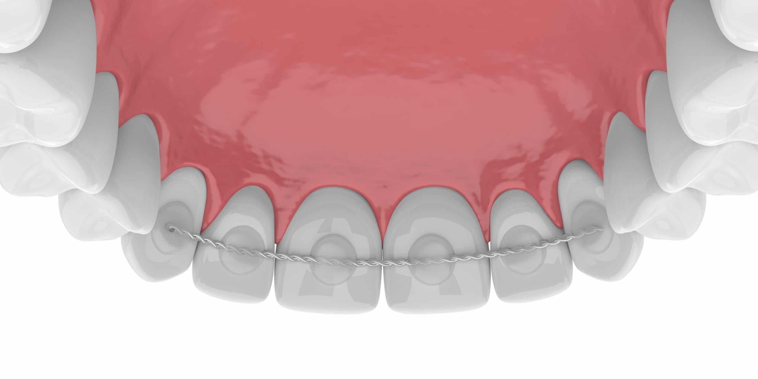 Fixed Retainers: Why They Matter, and How to Care for Them