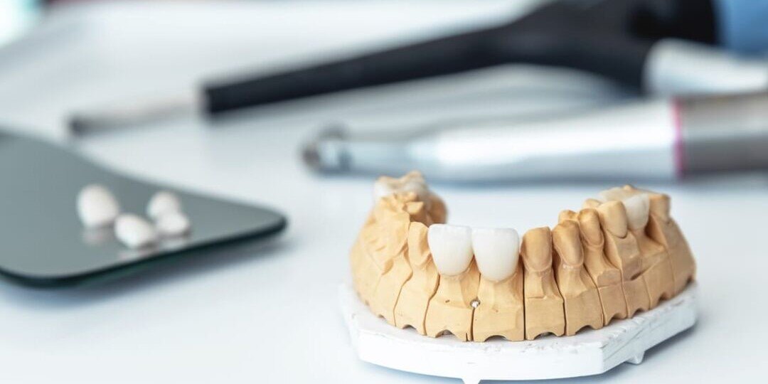 Everything You to Know Porcelain Crowns Price - Dental Designs S'pore