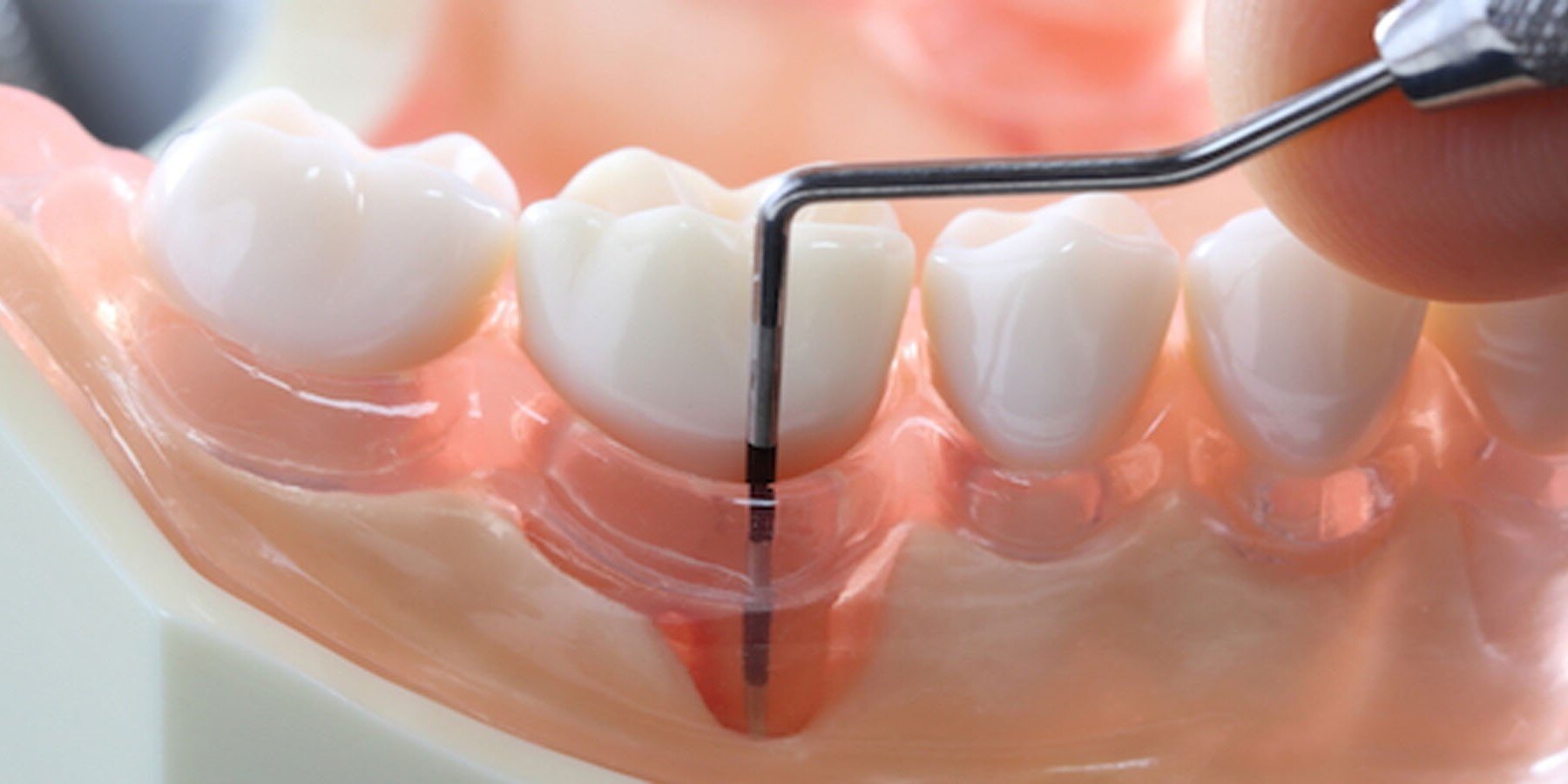 Periodontitis 101: Degenerative Gum Disease Treatment - Dental Designs